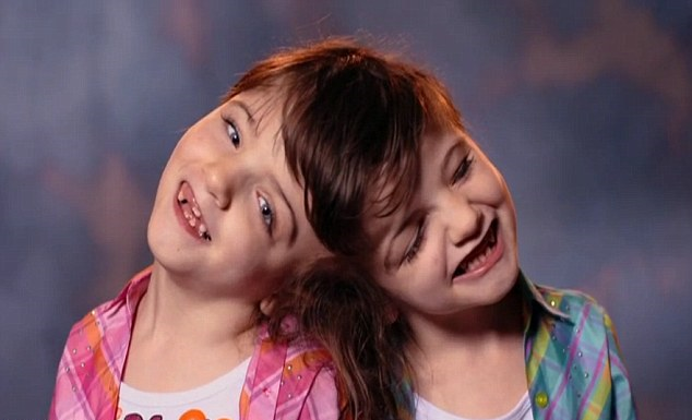 World News: Meet the conjoined twins that can never be separated