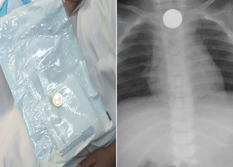 Kuwait: Boy who swallowed metallic coin saved