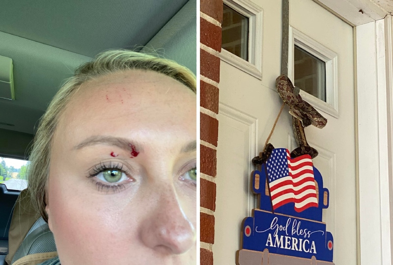 OMG: US woman bit by snake on her face